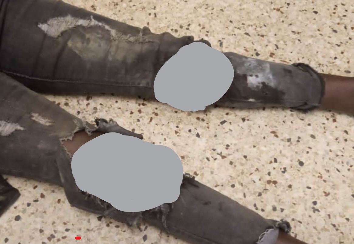 MUST Strike: Tear Gas Canister Rips Student’s Leg, 6 Others Severely ...